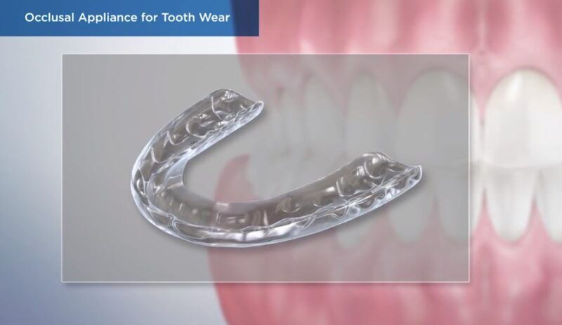 Why Choose Custom-Fit Bite Guards | Artisan Dental in Madison, WI